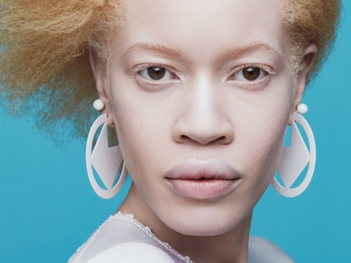 La modella albina che vuole rivoluzionare i canoni della bellezza | TPI