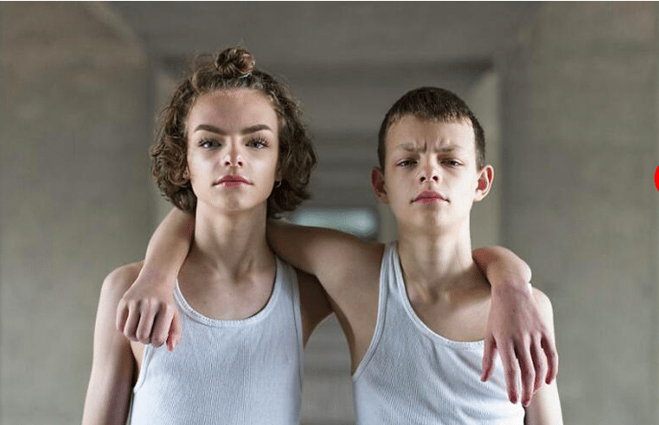 Le fotografie che mostrano le differenze dei gemelli omozigoti