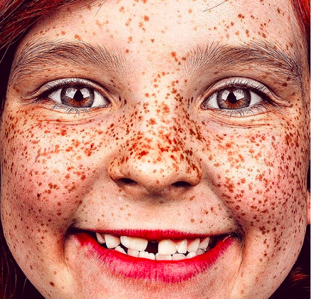La bellezza delle lentiggini in una serie di foto | TPI