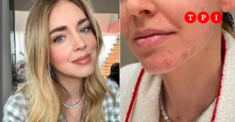 Chiara Ferragni mostra il viso con i segni dell’acne: “Nessuno è perfetto"