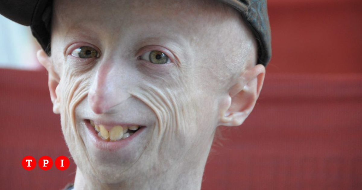È morto Sammy Basso: aveva 28 anni. Malattia, cause morte